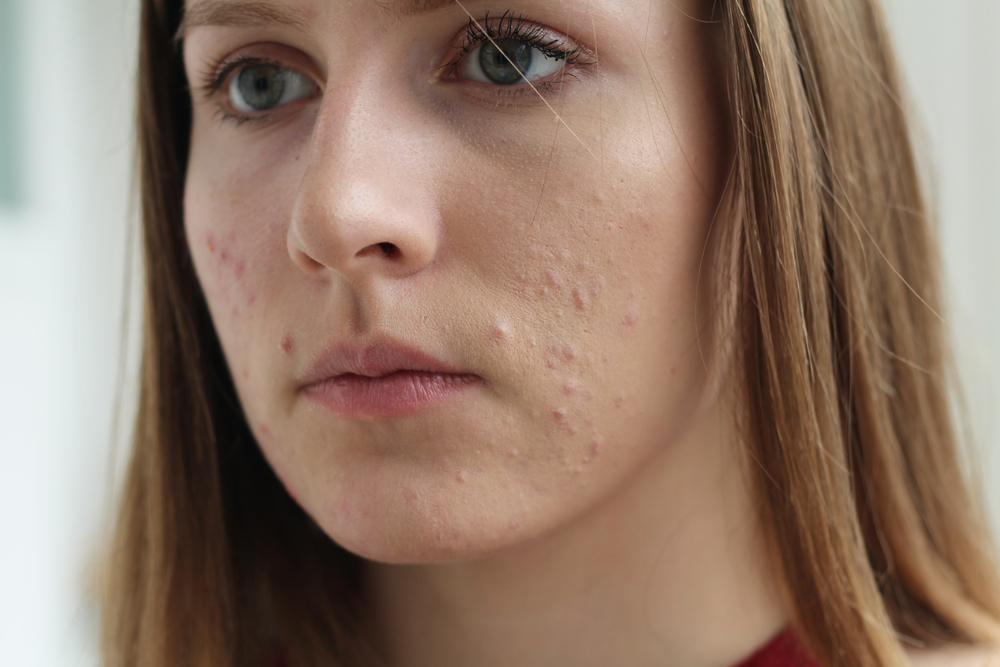 Teenage Acne: Effective Treatments, Causes and More