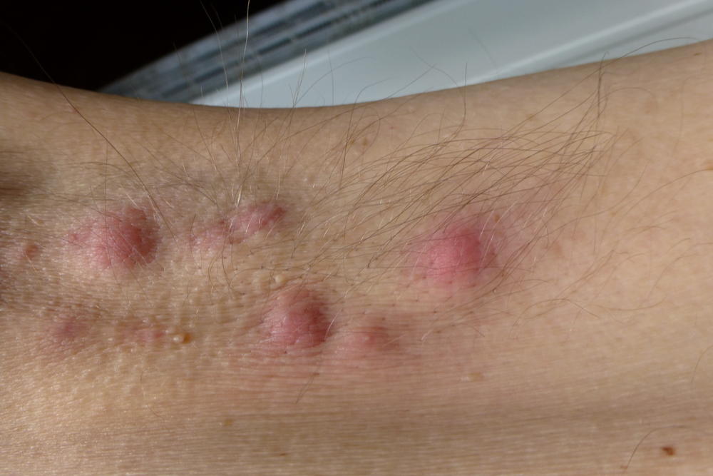 Acne Inversa (Hidradenitis Suppurativa): What It Is, Treatments, & Causes